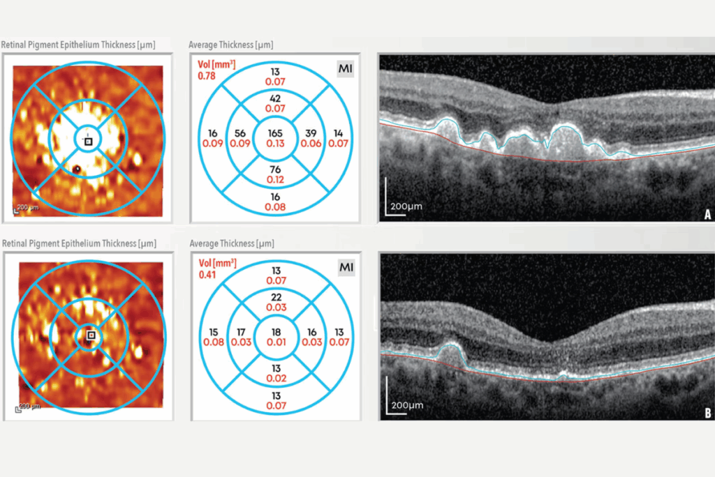 Treatment with Lumithera's Valeda | Macular Degeneration